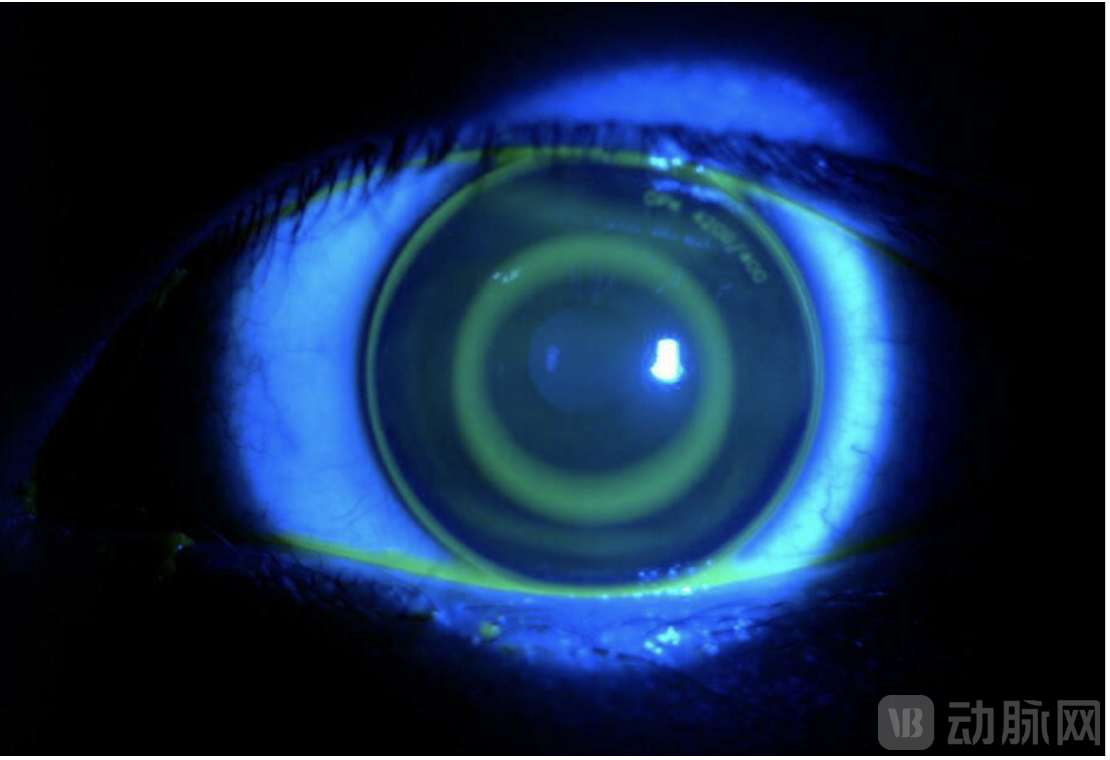 率先突破！唯仁医疗创新智能OCT引导角膜塑形镜数字化精准验配系统医药新闻-ByDrug-一站式医药资源共享中心-医药魔方