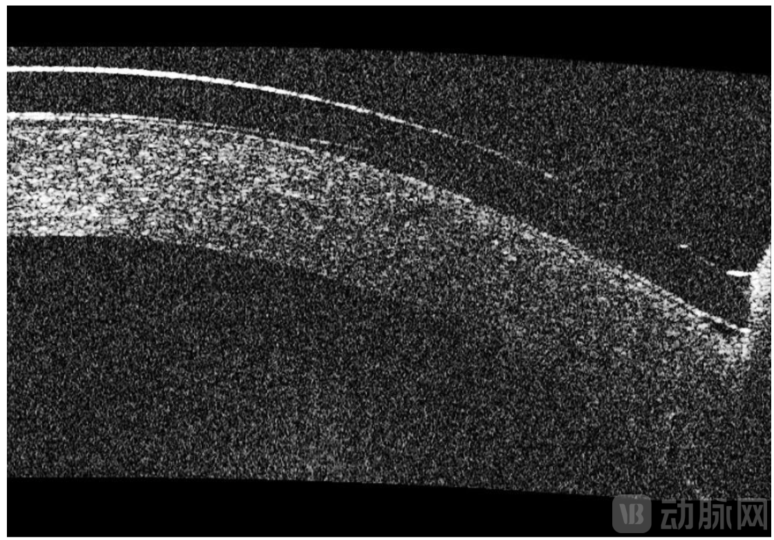 率先突破！唯仁医疗创新智能OCT引导角膜塑形镜数字化精准验配系统医药新闻-ByDrug-一站式医药资源共享中心-医药魔方