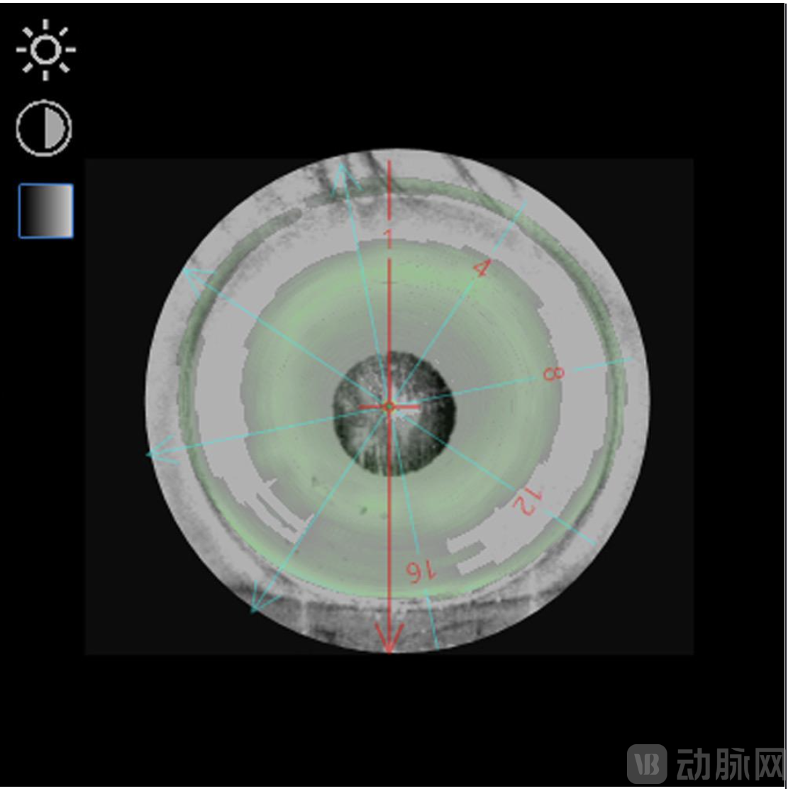 率先突破！唯仁医疗创新智能OCT引导角膜塑形镜数字化精准验配系统医药新闻-ByDrug-一站式医药资源共享中心-医药魔方