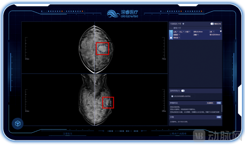 重磅！国家药监局颁发首张乳腺AI产品NMPA三类证 l 深睿医疗第六证！-动脉网