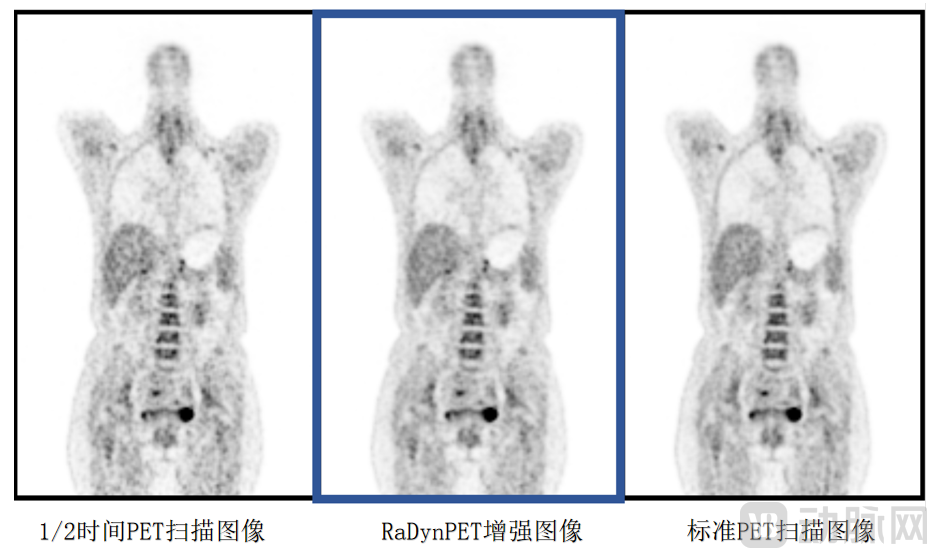 影动医疗国产人工智能医学影像重建增强技术逐步引领全球-动脉网
