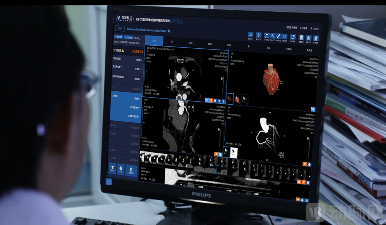 心血管AI进入精准诊断评估时代，数坤科技冠脉CTA AI再获NMPA三类证-动脉网
